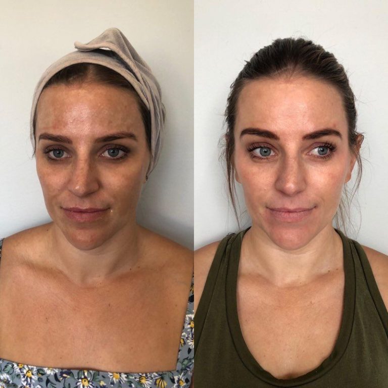 Cosmelan® Peel from $1199