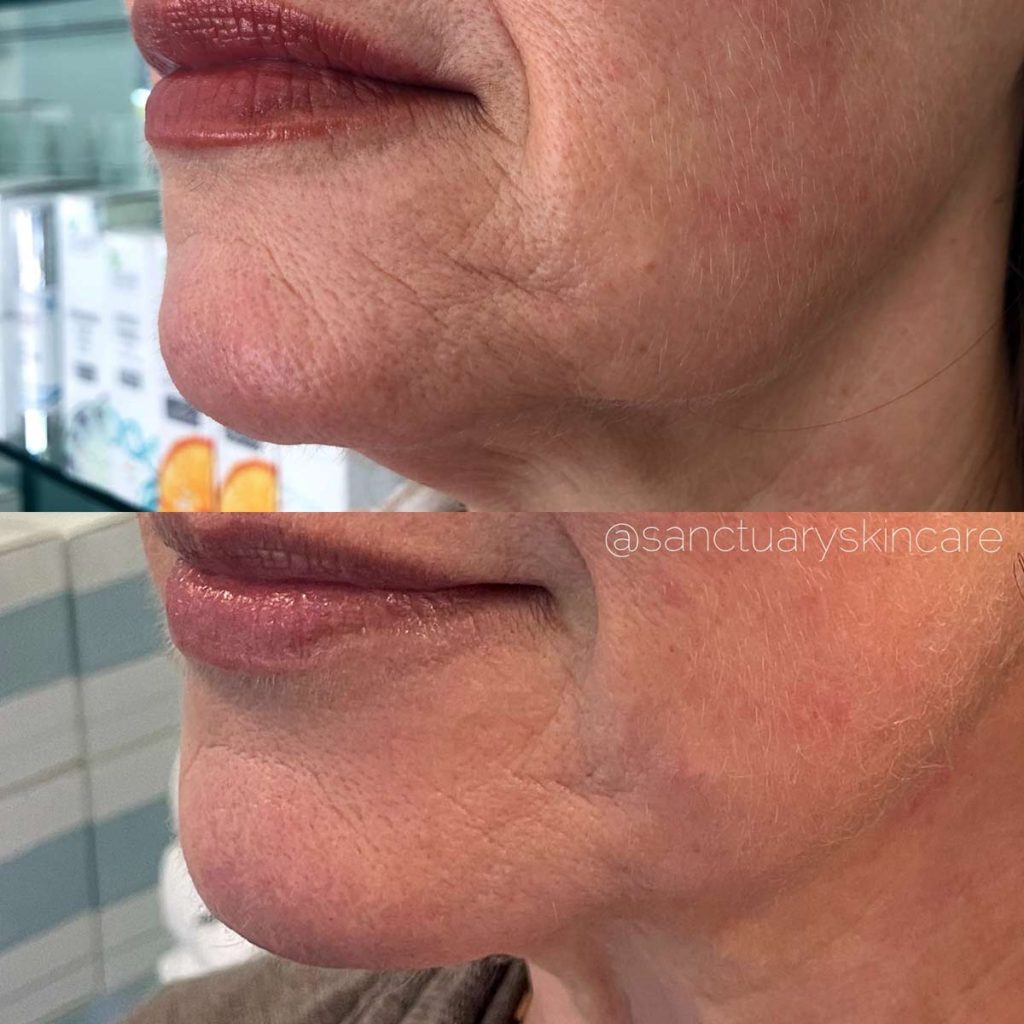 HIFU – Non-Surgical Facelift