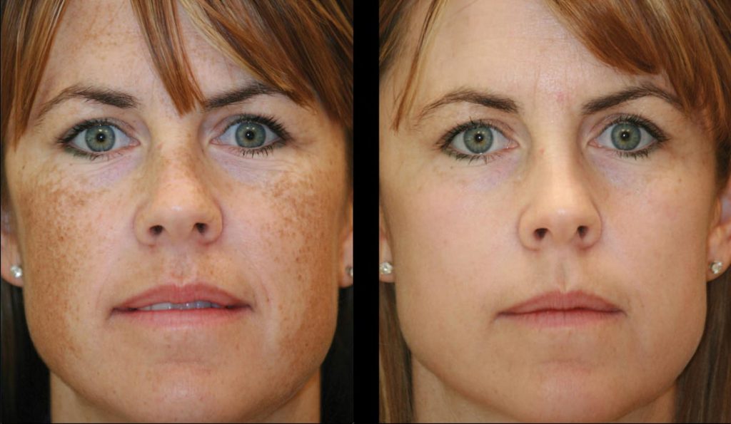 BBL – Broadband Light Therapy (IPL)