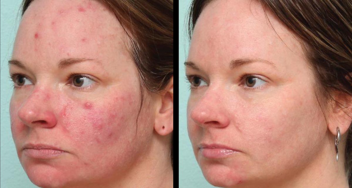 BBL – Broadband Light Therapy (IPL)