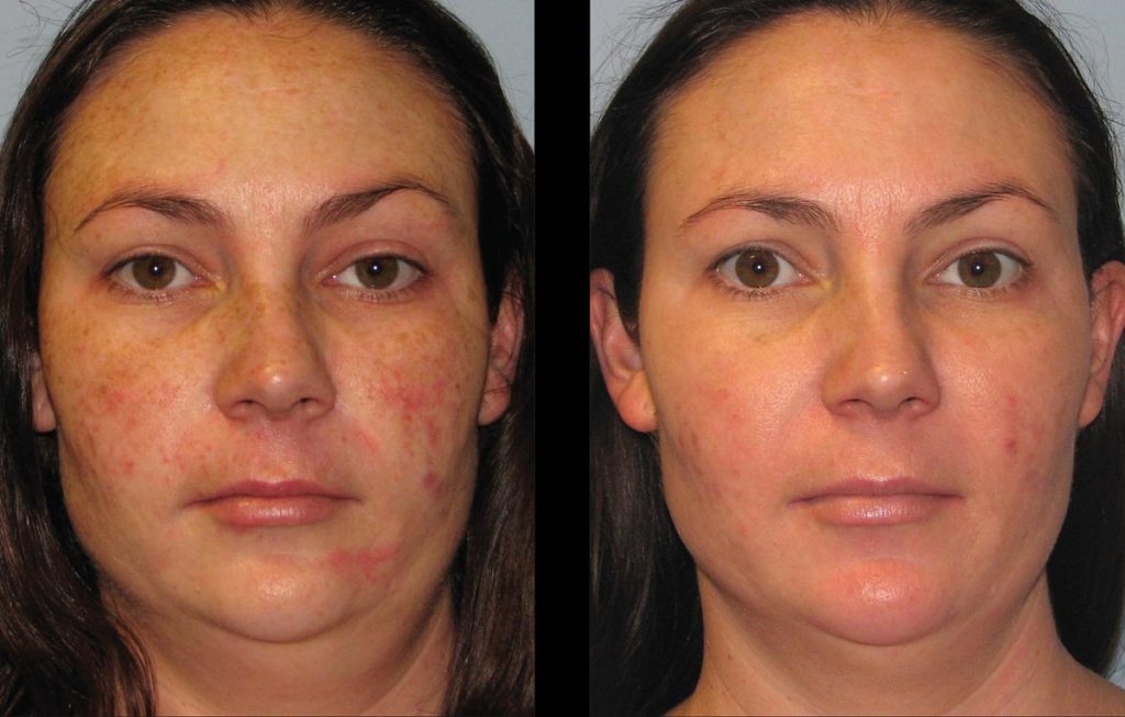 BBL – Broadband Light Therapy (IPL)