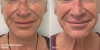 Tixel Skin Tightening