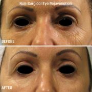 Tixel Skin Tightening