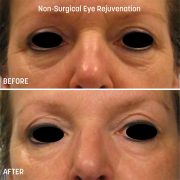 Tixel Skin Tightening