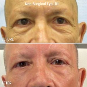 Tixel Skin Tightening