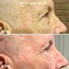Tixel Skin Tightening