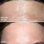 Tixel Skin Tightening