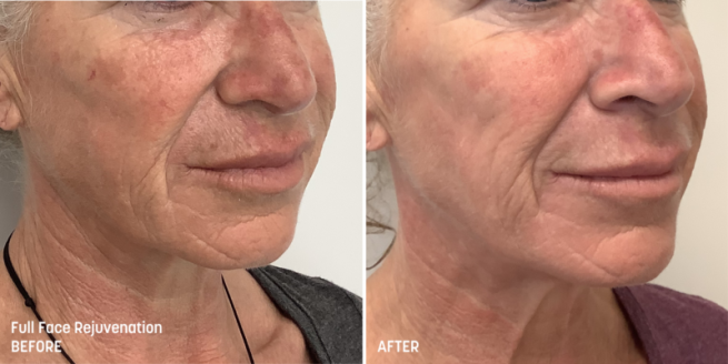 Tixel Skin Tightening