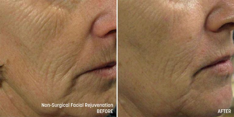 Tixel Skin Tightening