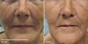Tixel Skin Tightening