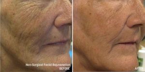 Tixel Skin Tightening
