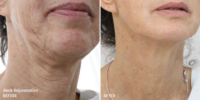 Tixel Skin Tightening