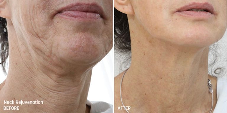 Tixel Skin Tightening
