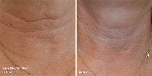 Tixel Skin Tightening
