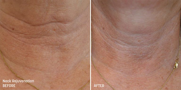 Tixel Skin Tightening