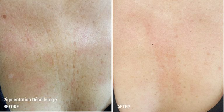 Tixel Skin Tightening
